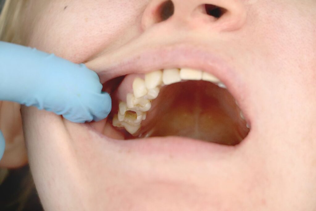 5 Warning Signs of Tooth Decay You Should Never Ignore